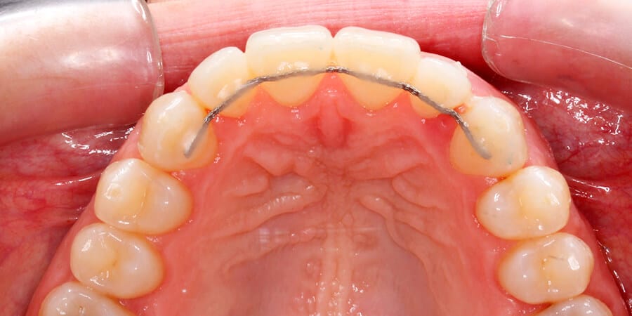 ¿Cuánto tiempo hay que llevar el retenedor fijo de ortodoncia? – Vélez ...