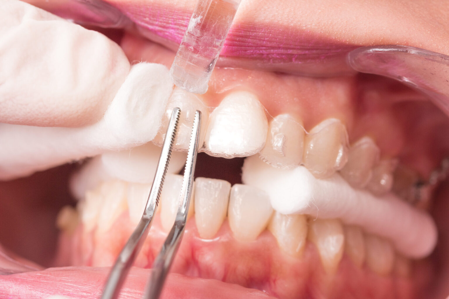 ¿Cómo se colocan los ataches de Invisalign sobre los dientes ...