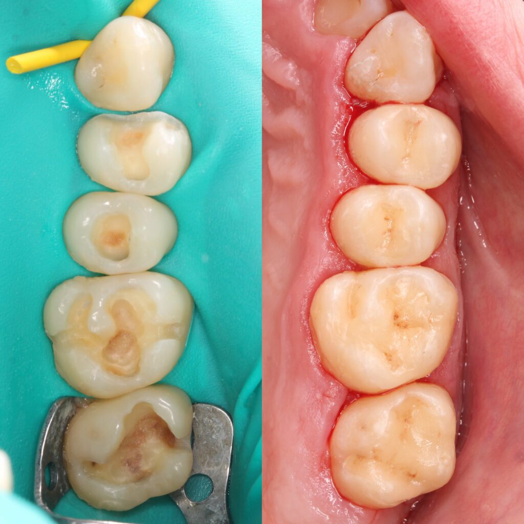 Composite: qué es y para qué se usa en odontología - Vélez & Lozano
