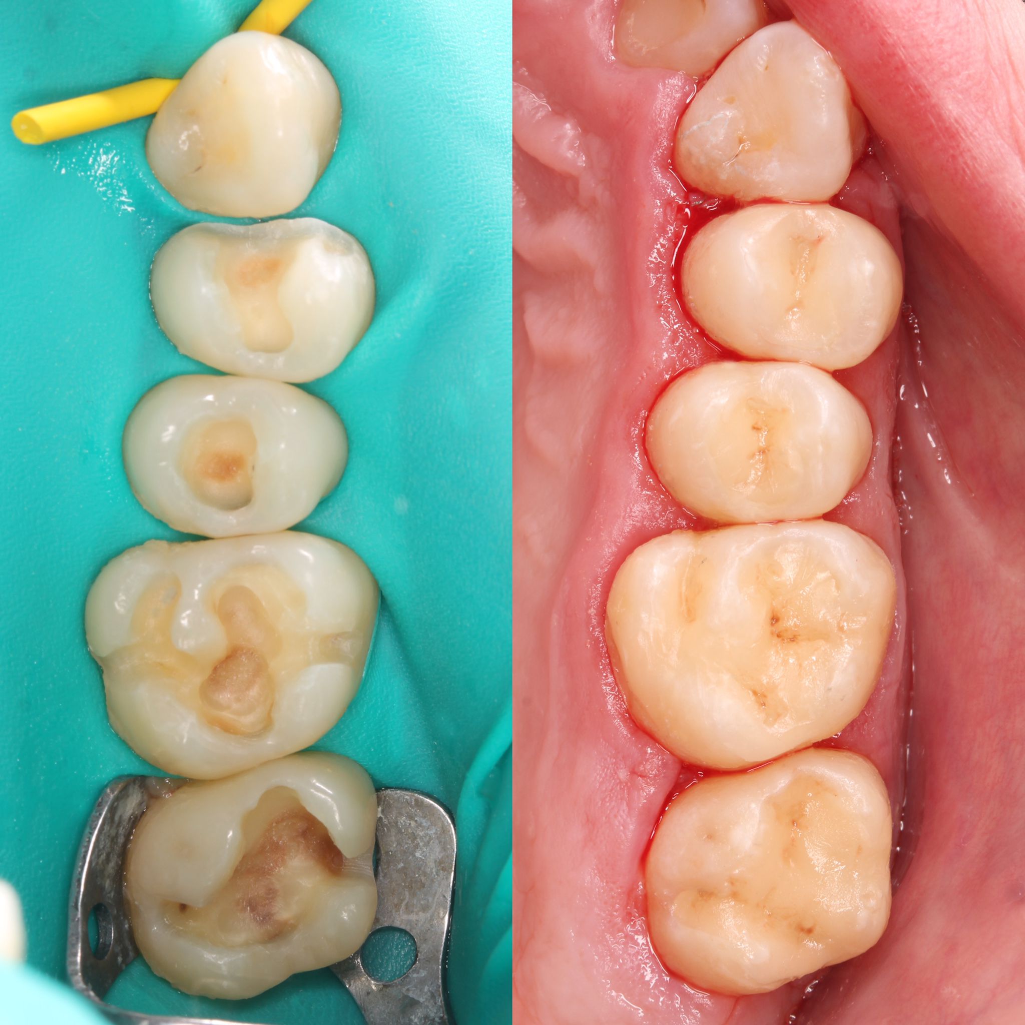 Composite: qué es y para qué se usa en odontología - Vélez & Lozano