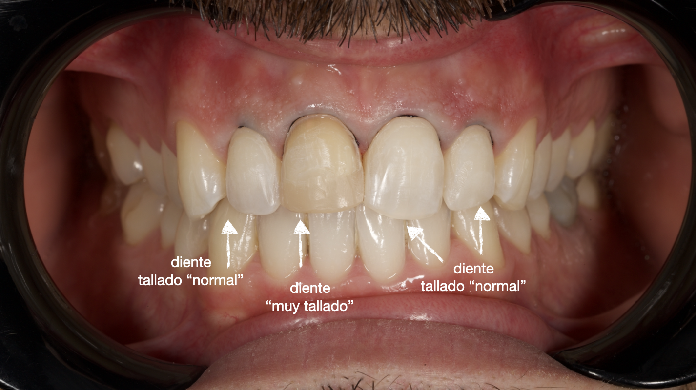 Carillas dentales: paso a paso - Vélez & Lozano