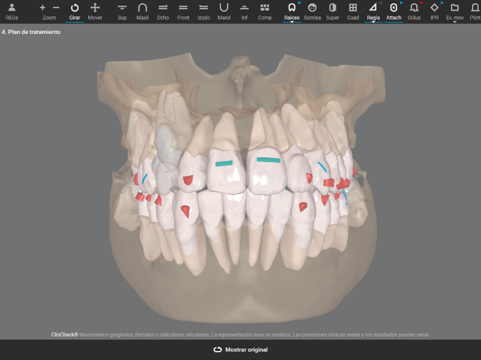 El CBCT ha llegado a Invisalign, ¿por qué es importante? - Vélez & Lozano