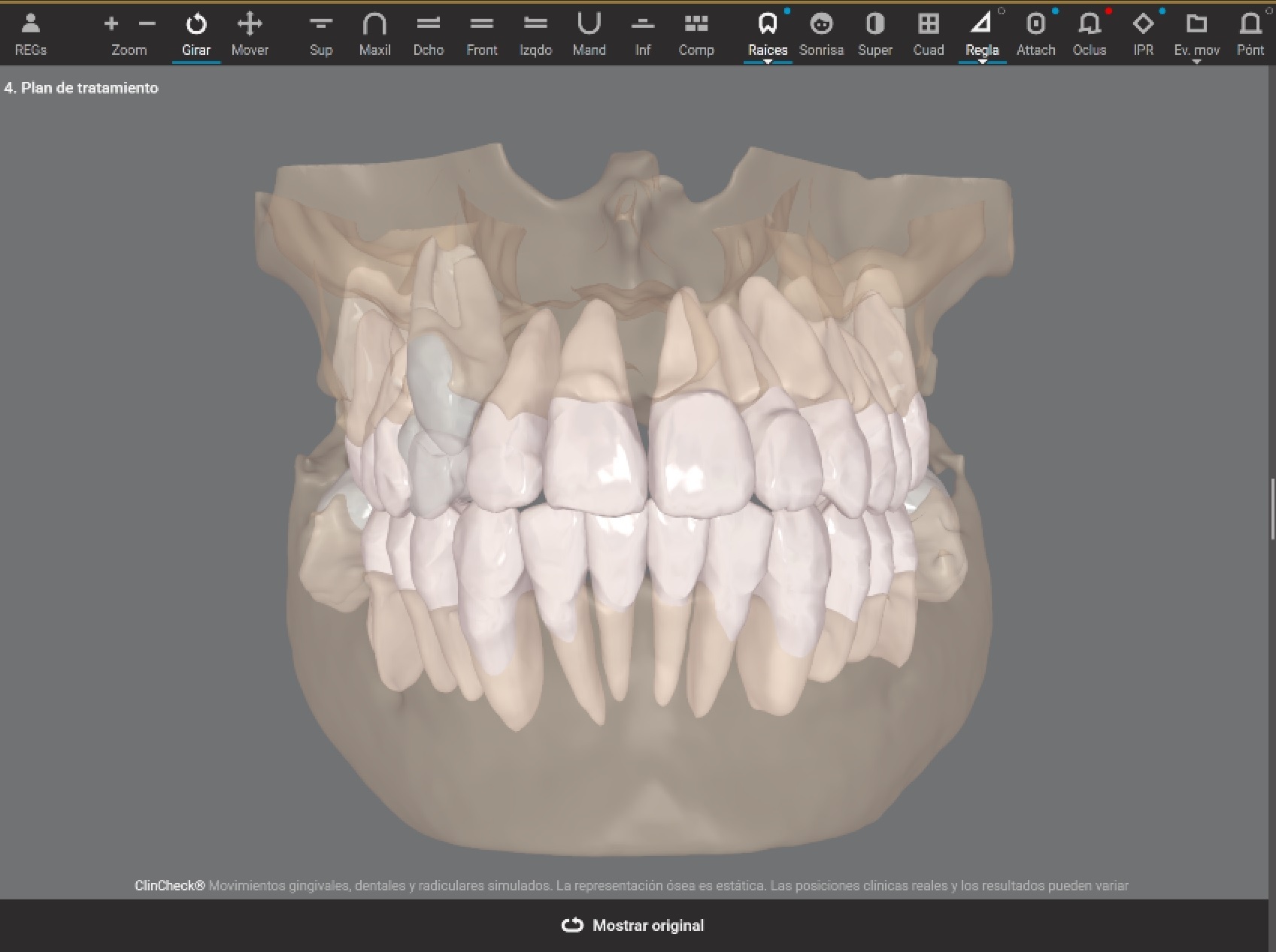 El CBCT ha llegado a Invisalign, ¿por qué es importante? - Vélez & Lozano