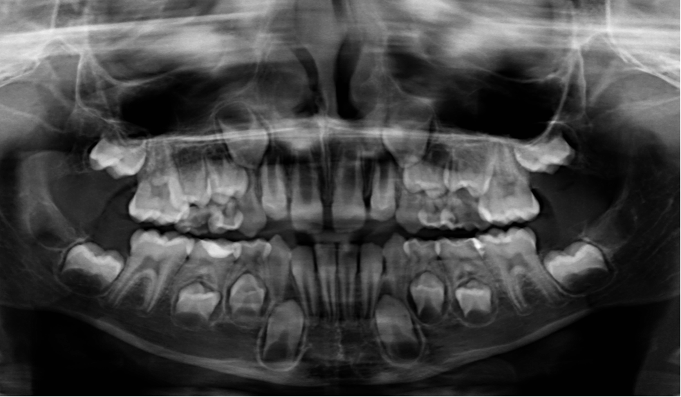 ¿Los dientes de leche tienen raíz? - Vélez & Lozano