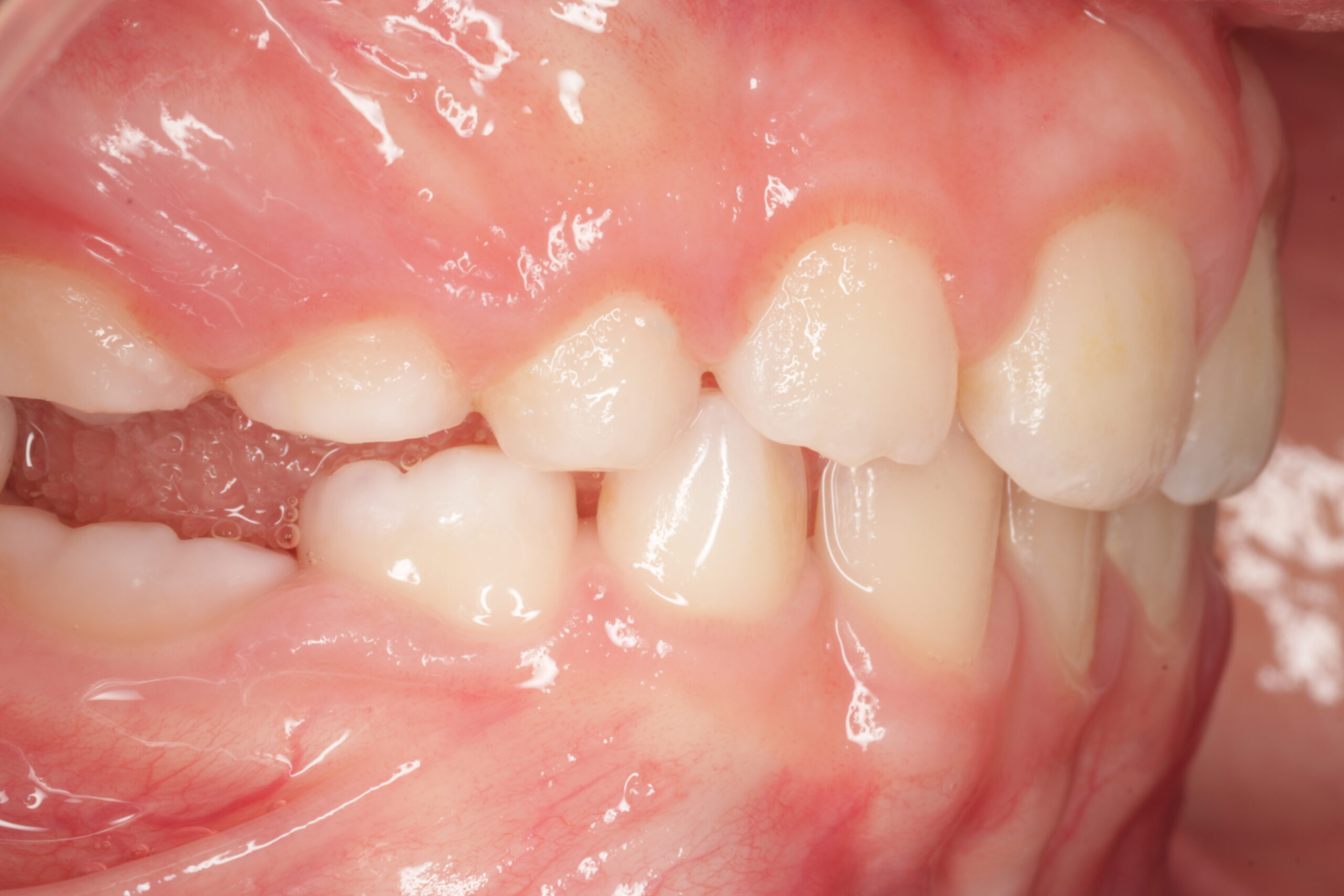 'Why doesn't a tooth come out completely?': Dental Ankylosis - Vélez ...