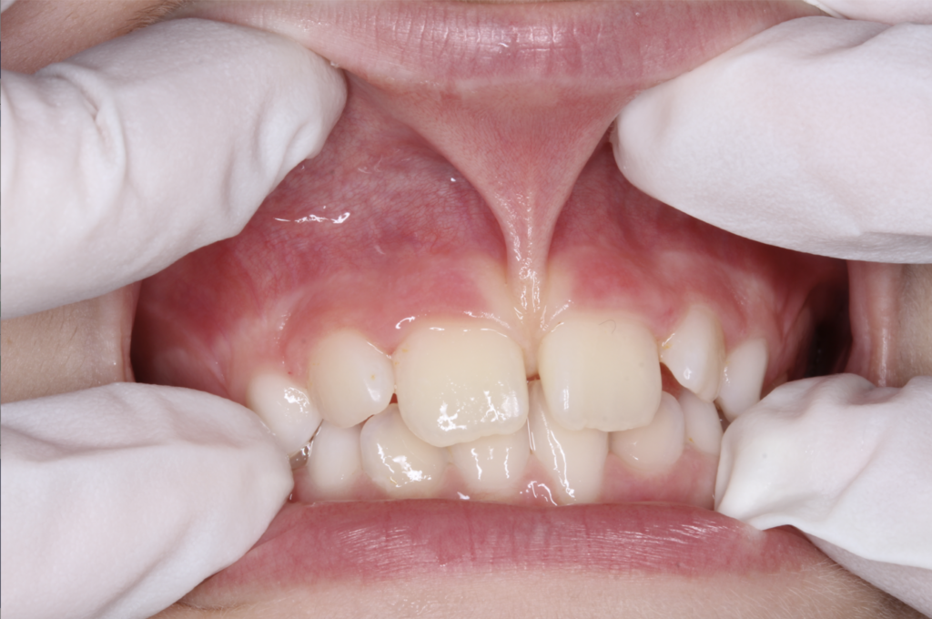 What is a frenectomy? - Velez & Lozano